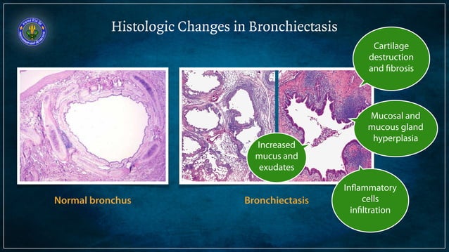 Bronchiectasis - causes and diagnosis | PDF