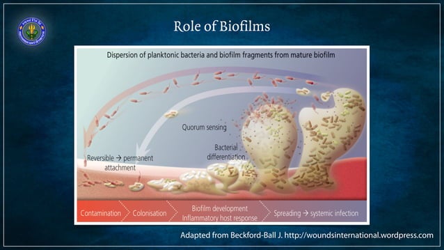 Bronchiectasis - causes and diagnosis | PDF