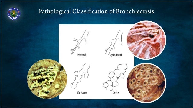 Bronchiectasis - causes and diagnosis