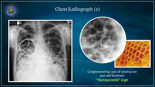 Bronchiectasis - causes and diagnosis