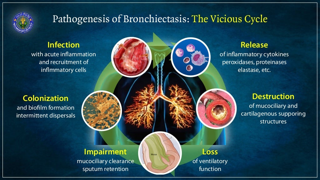 Pathophysiology Of Bronchiectasis Bronchiectasis Diagnosis And | Images ...