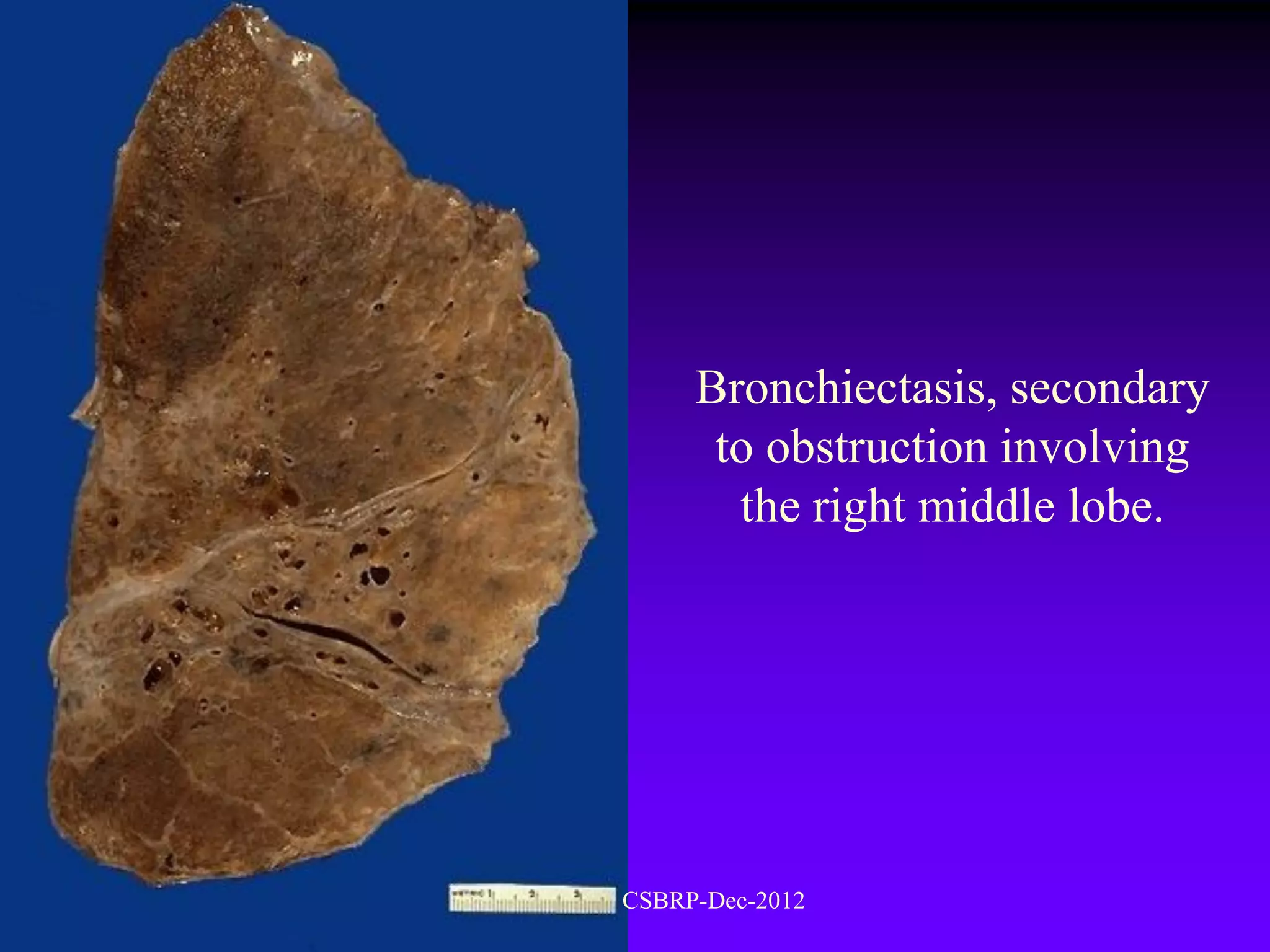 Bronchiectasis | PDF