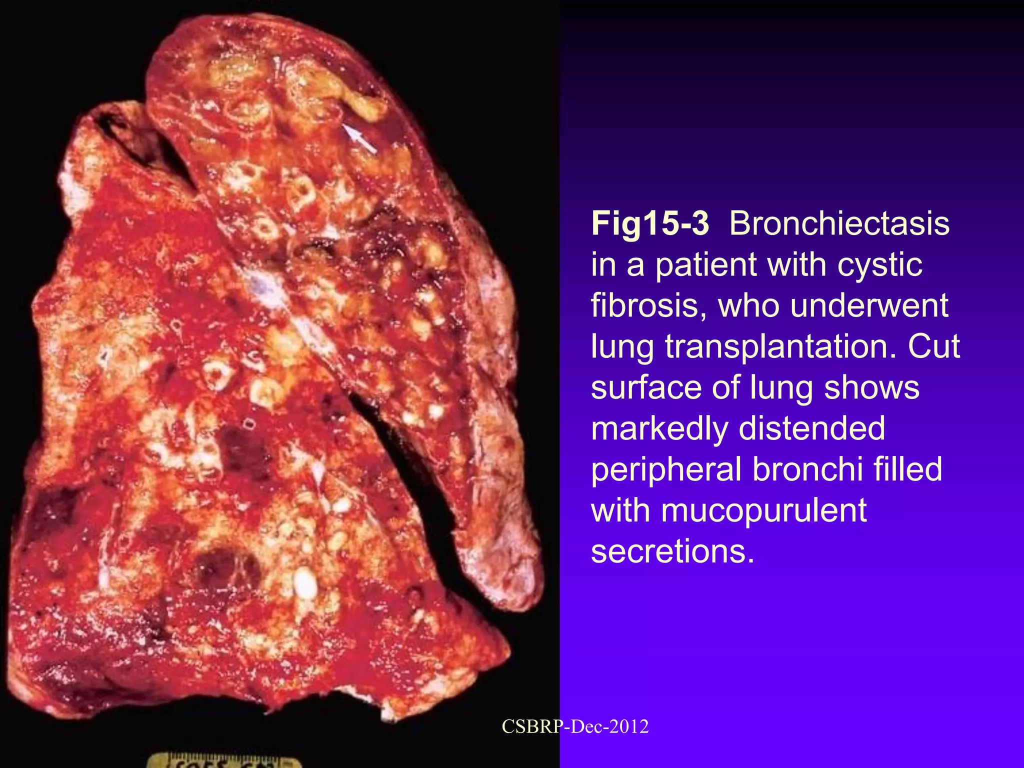 Bronchiectasis | PDF