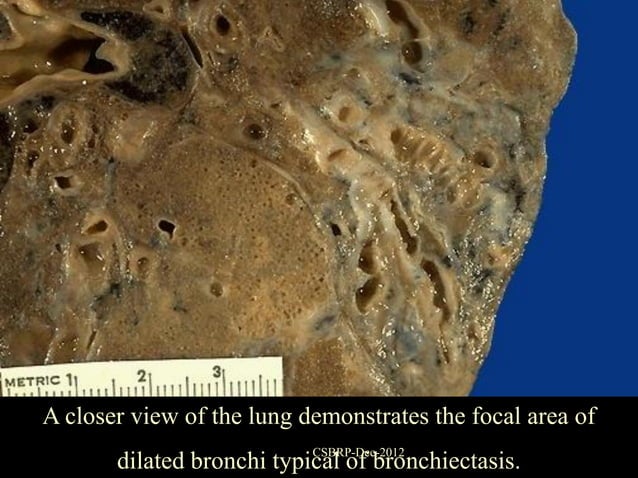 Bronchiectasis | PDF | Lung and Respiratory Health | Diseases and ...