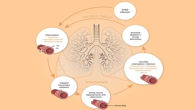 BRONCHIECTASIS and its causes and management.pptx