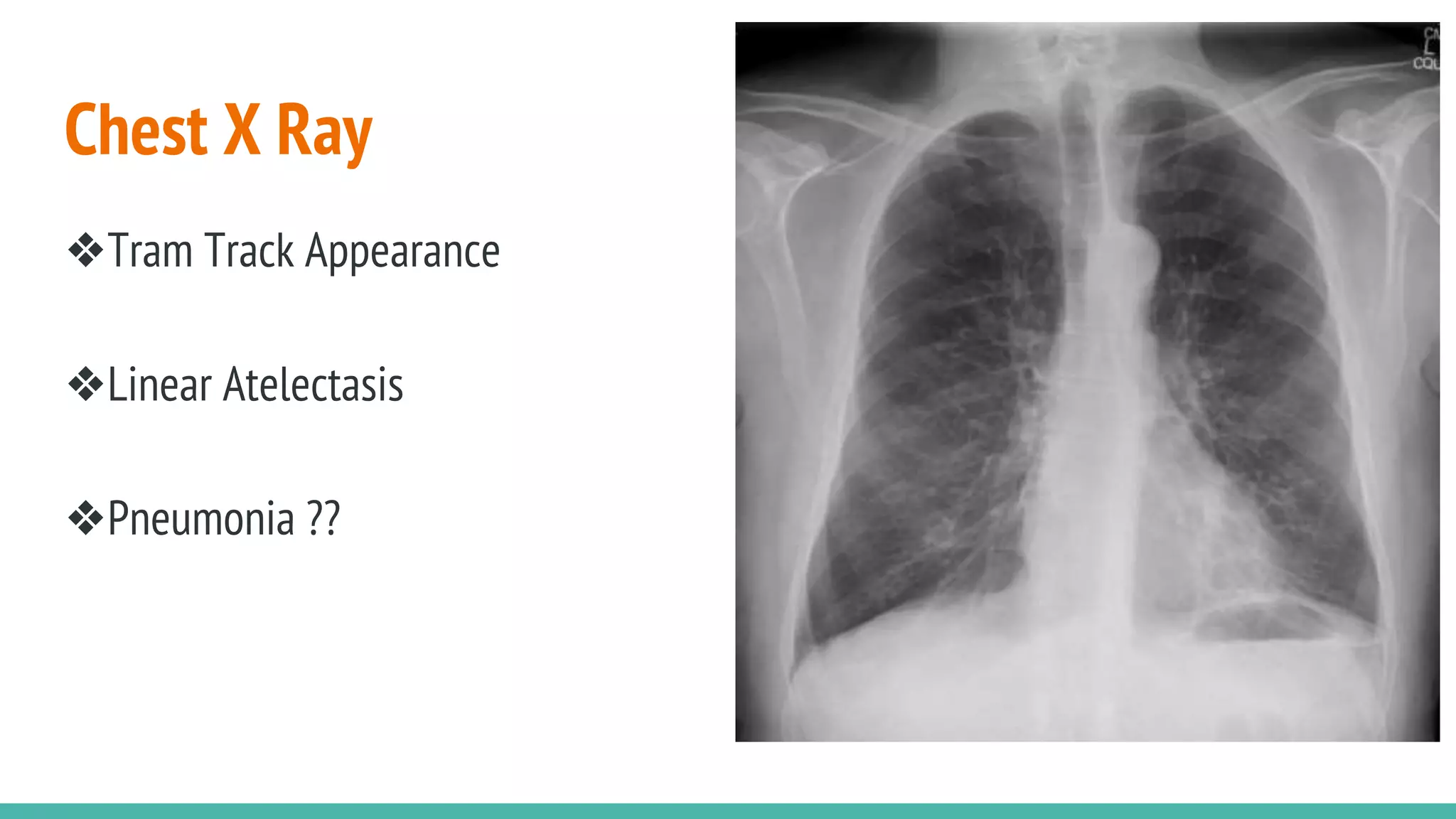 Bronchiectasis | PPTX