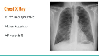 Bronchiectasis | PPTX