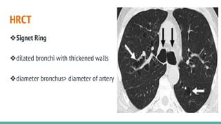 Bronchiectasis | PPTX