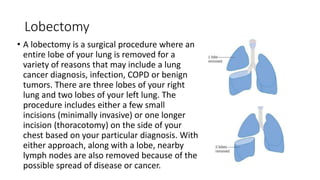Bronchiectasis | PPT