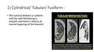 Bronchiectasis | PPT