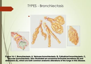 Bronchiectasis BSC.pdf