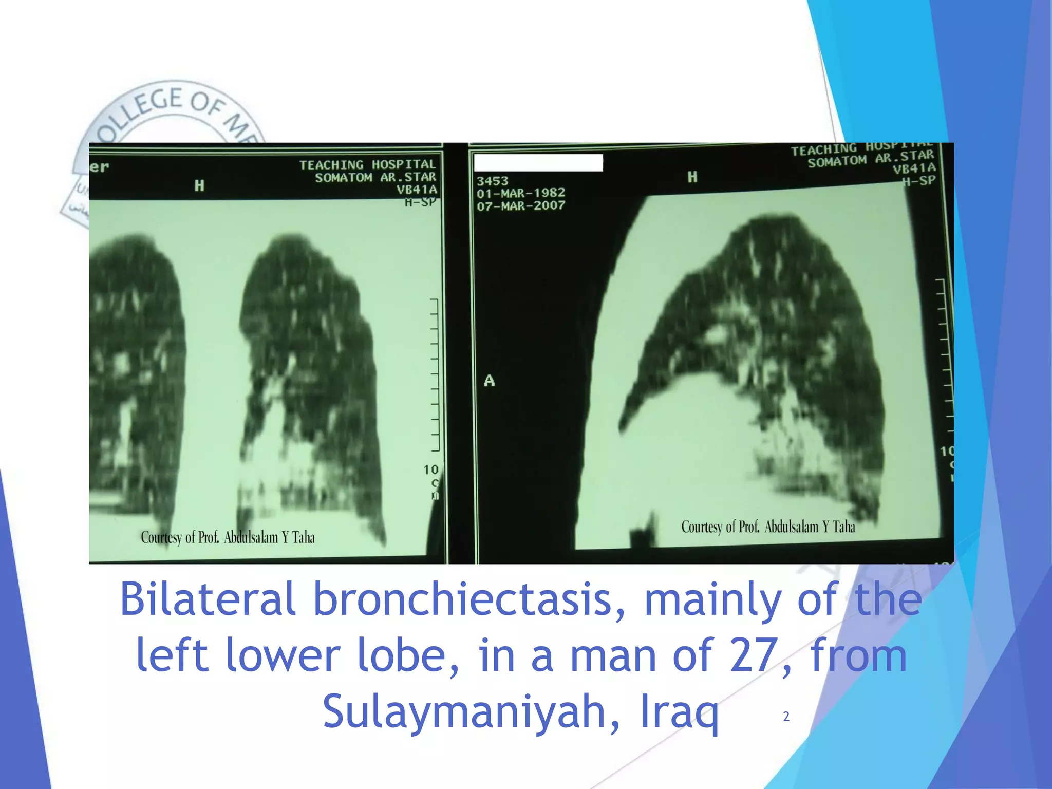 Bronchiectasis of the Left Lower Lobe.pdf