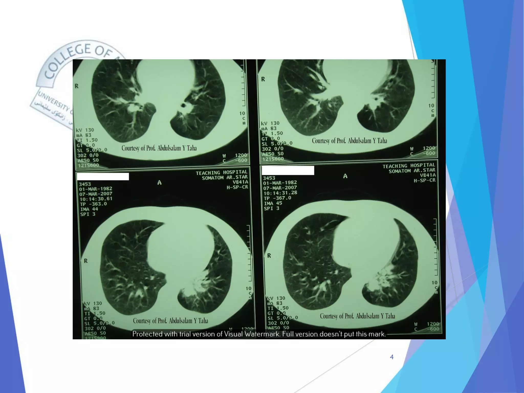 Bronchiectasis of the Left Lower Lobe.pdf