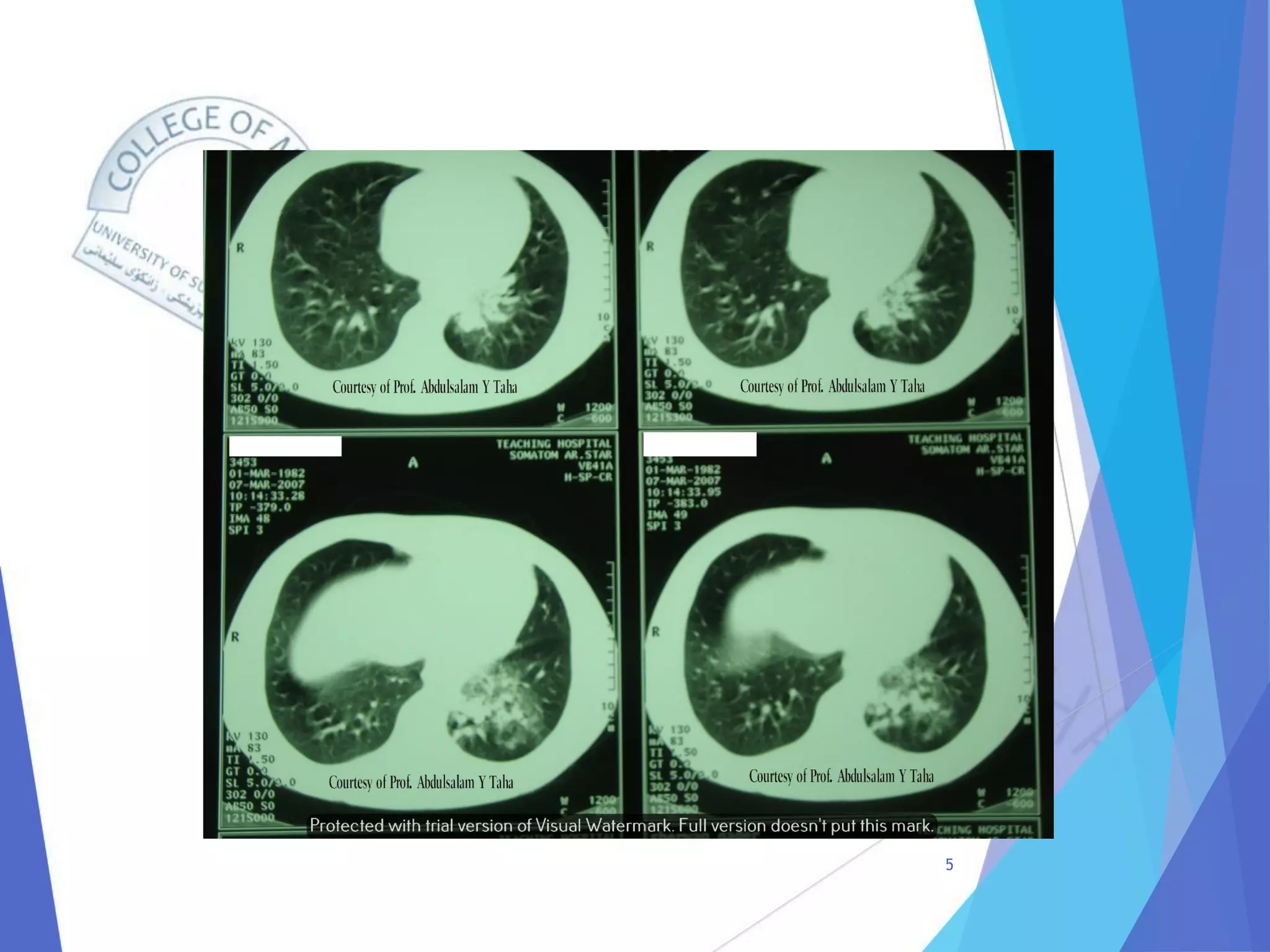 Bronchiectasis of the Left Lower Lobe.pdf