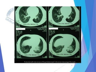 Bronchiectasis of the Left Lower Lobe.pdf