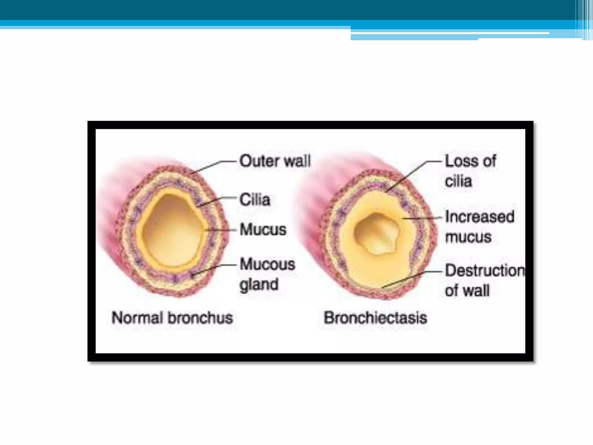 Bronchiectasis | PPTX