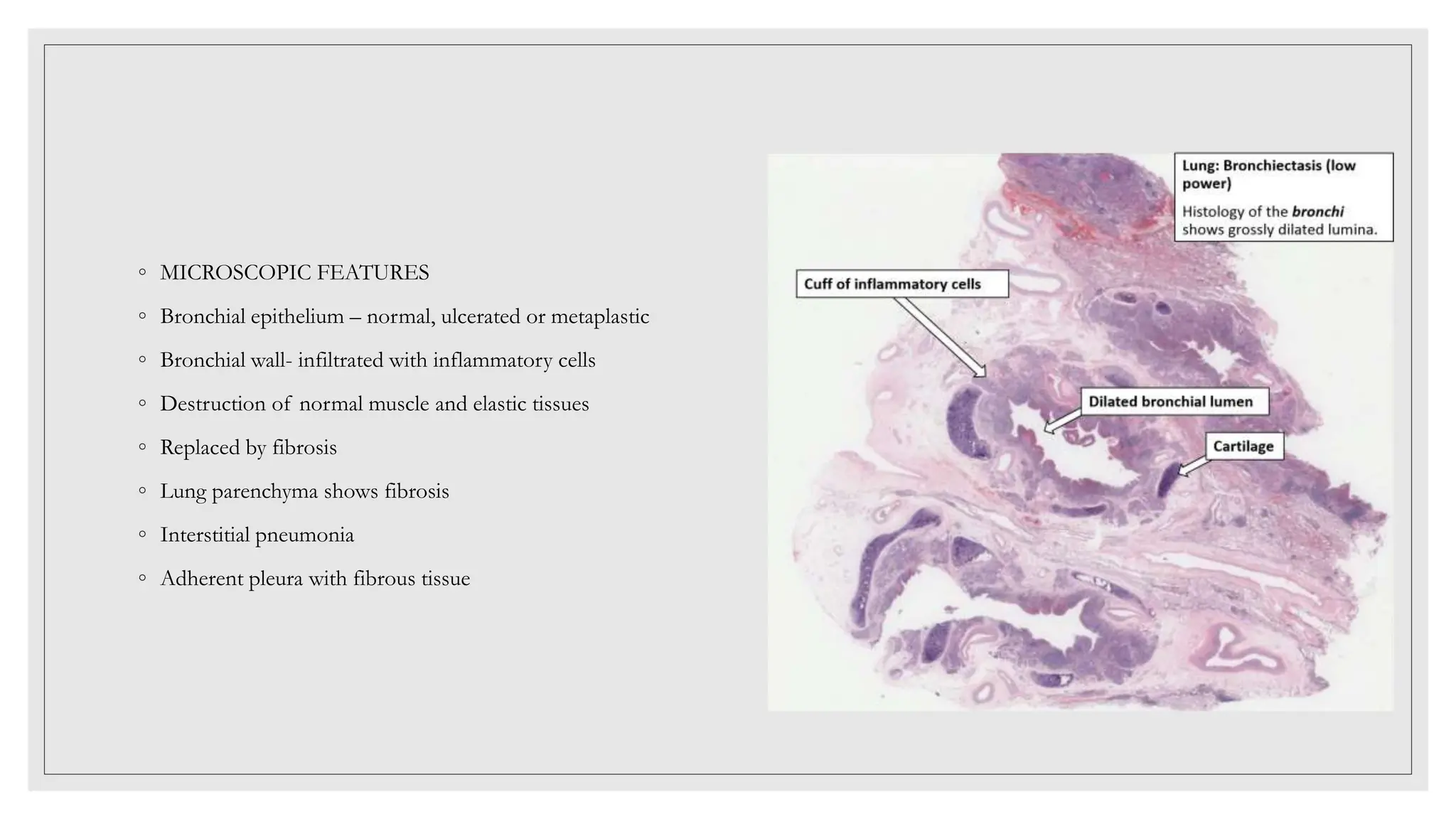 BRONCHIECTASIS PATHOLOGY FOR NURSES.pptx