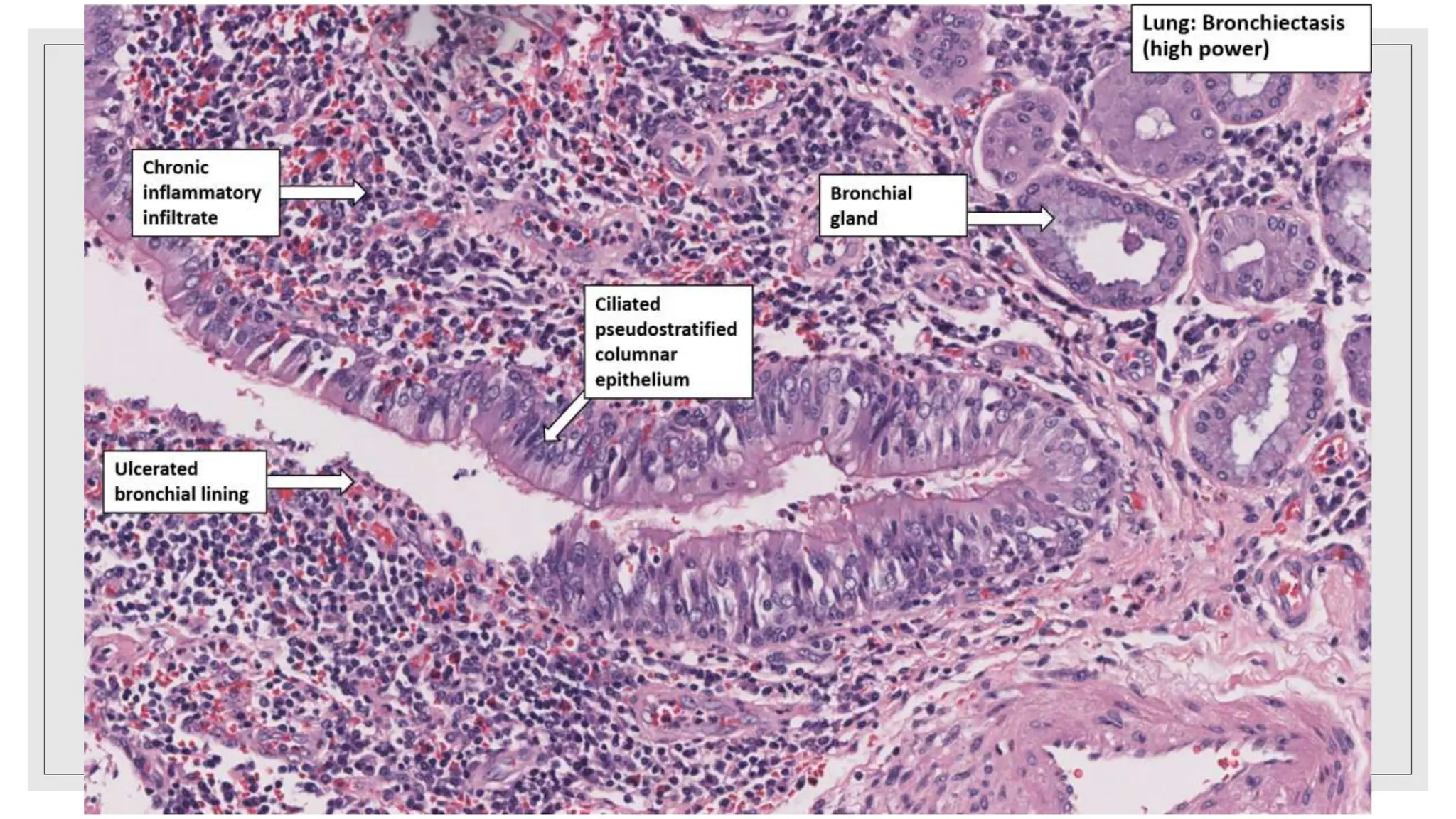 BRONCHIECTASIS PATHOLOGY FOR NURSES.pptx