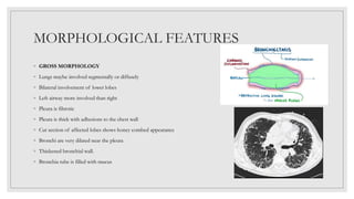 BRONCHIECTASIS PATHOLOGY FOR NURSES.pptx