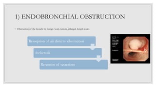 BRONCHIECTASIS PATHOLOGY FOR NURSES.pptx