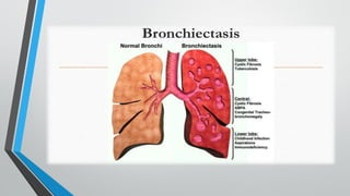 Bronchiectasis ppt | PDF