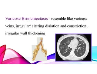 BRONCHIECTASIS PPT .pdf