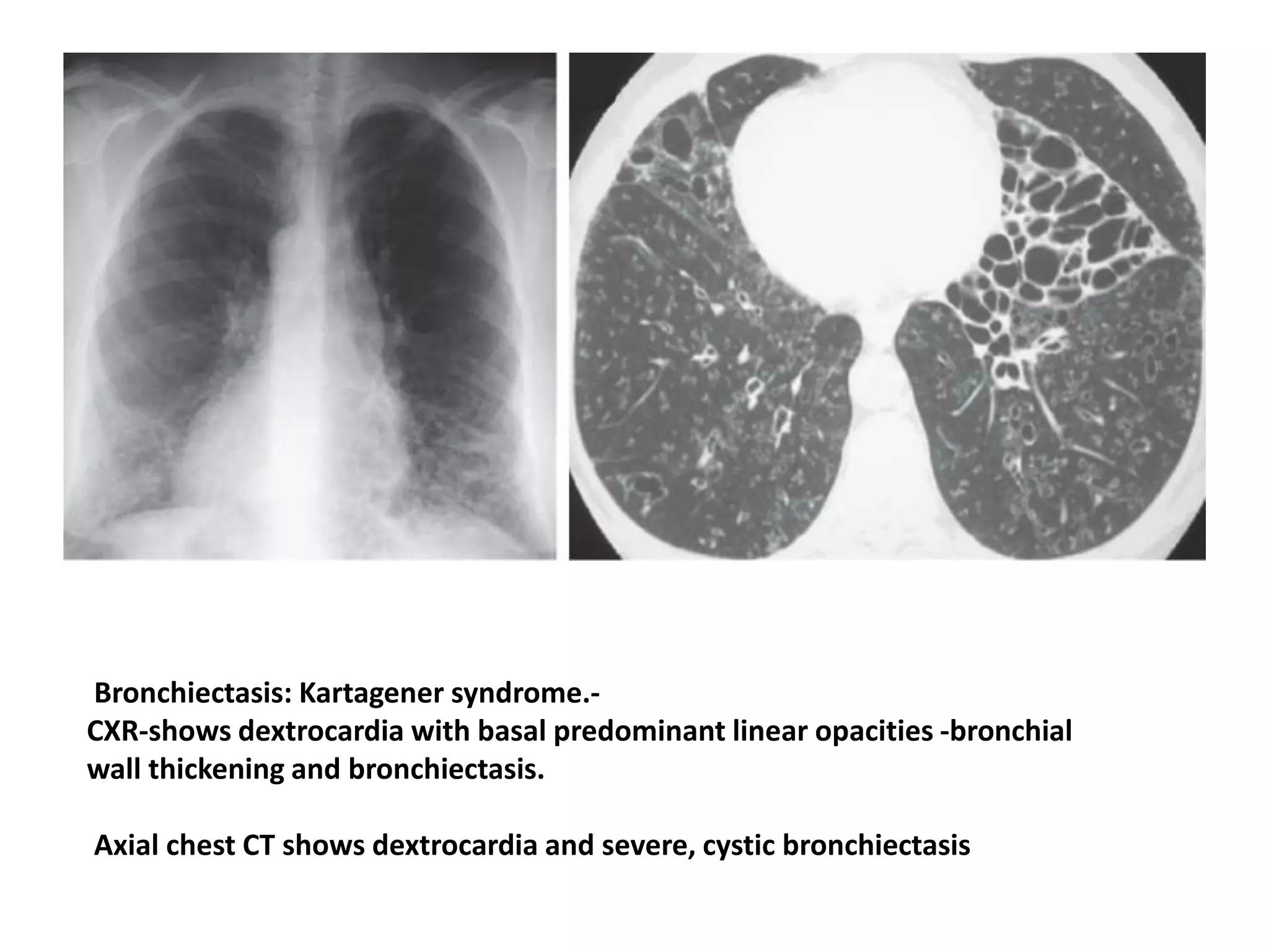 bronchiectasis Presentation1.pptx