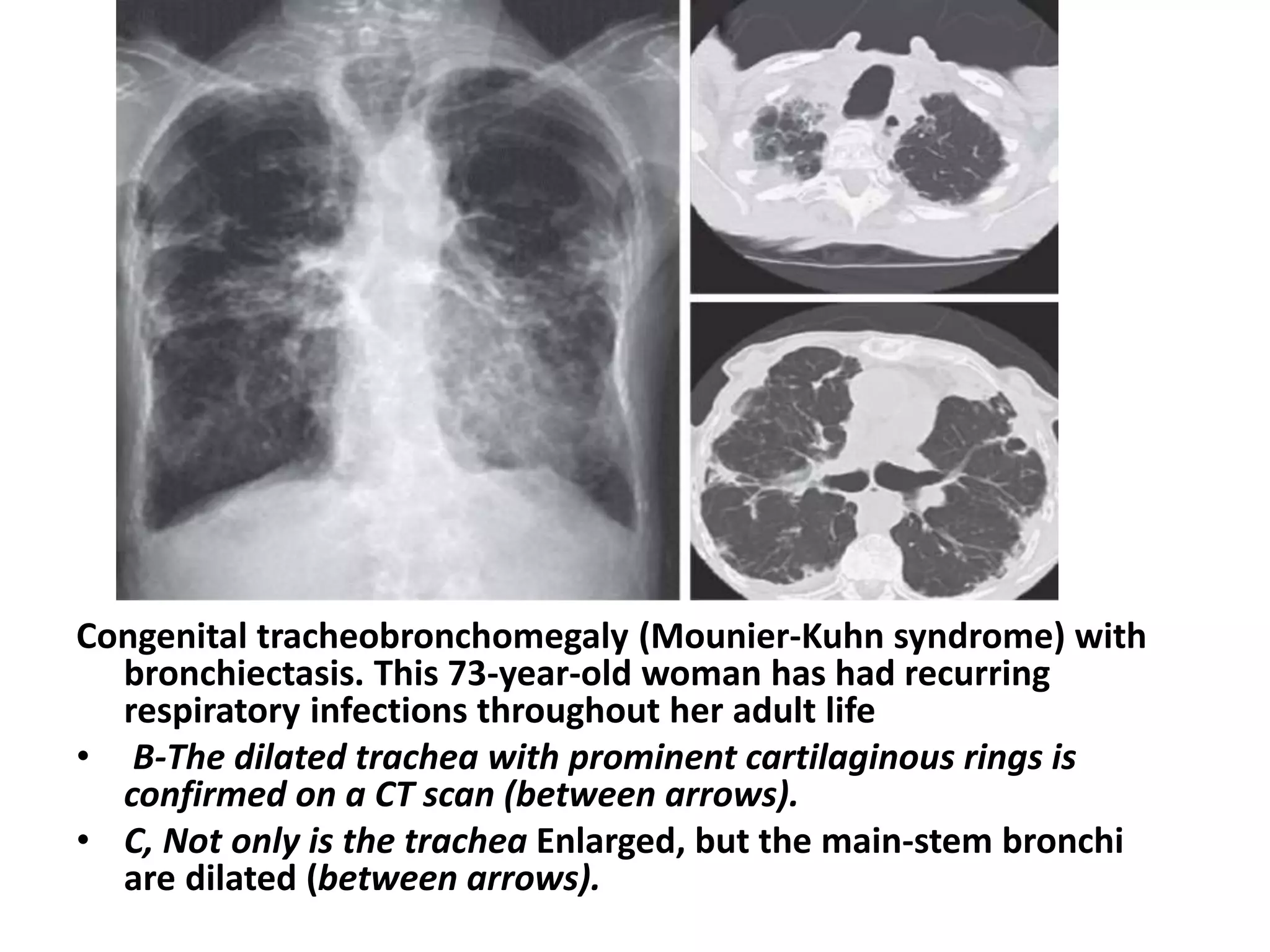 bronchiectasis Presentation1.pptx