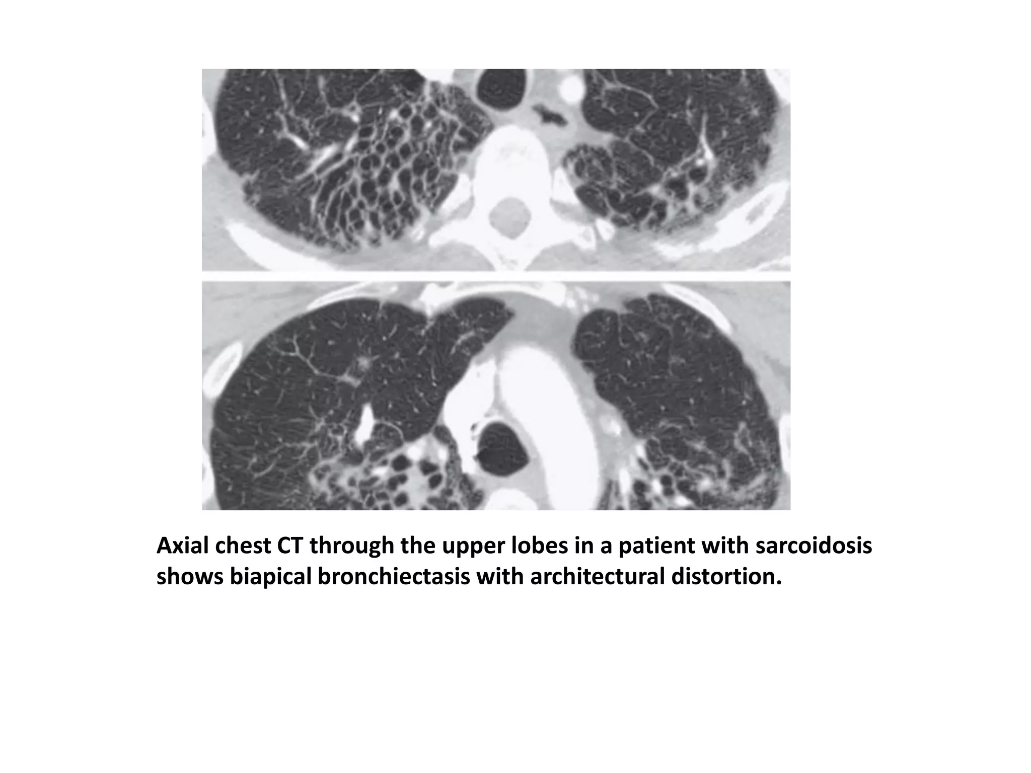 bronchiectasis Presentation1.pptx