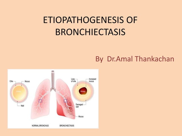 bronchiectasis Presentation1.pptx | Lung and Respiratory Health ...