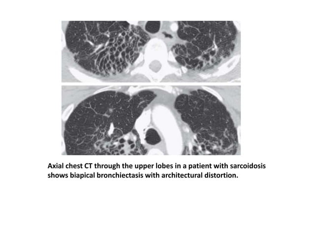 bronchiectasis Presentation1.pptx | Lung and Respiratory Health ...