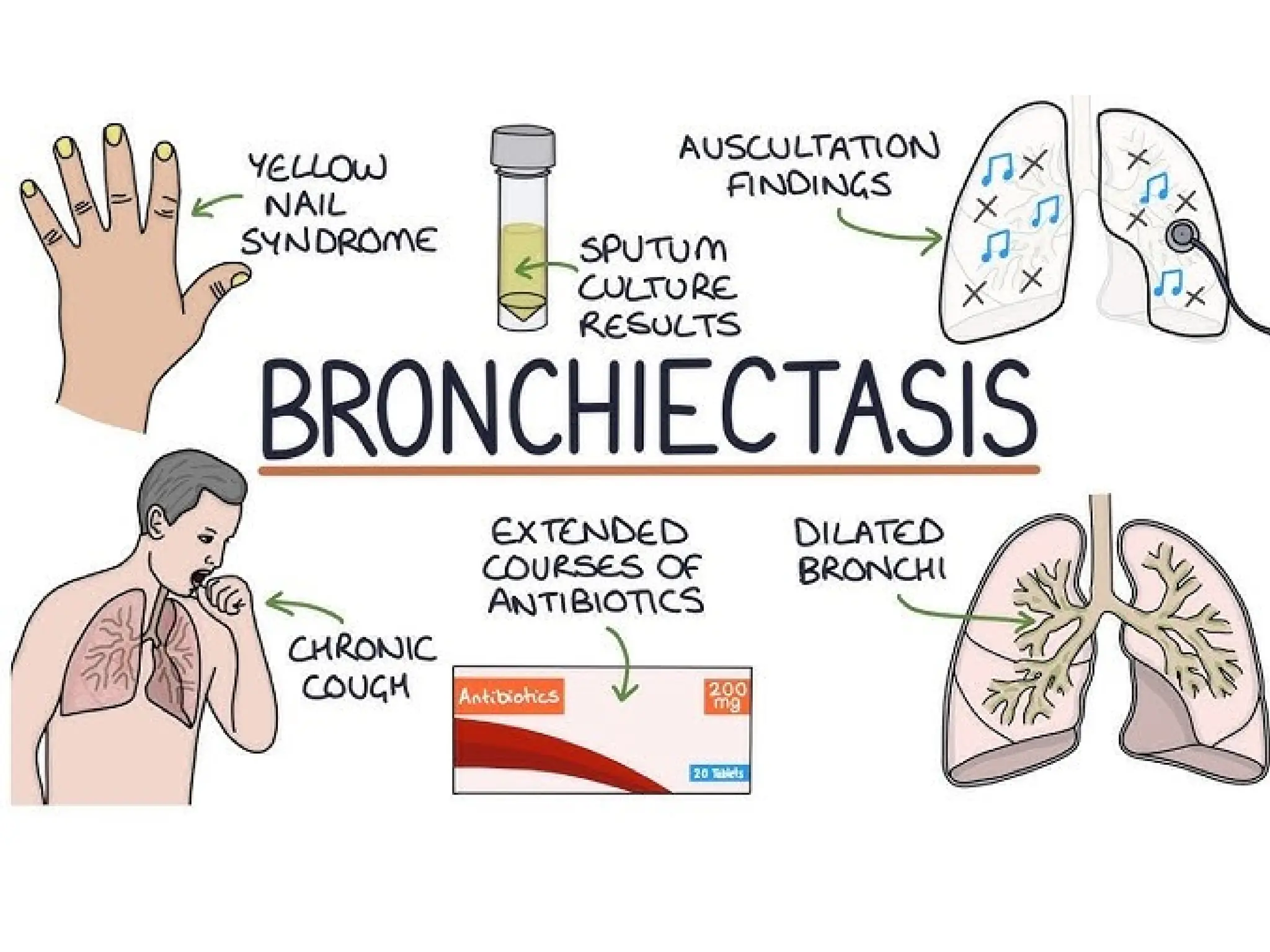 Bronchiectasis, primary ciliary dyskinesia, cystic fibrosis.pptx