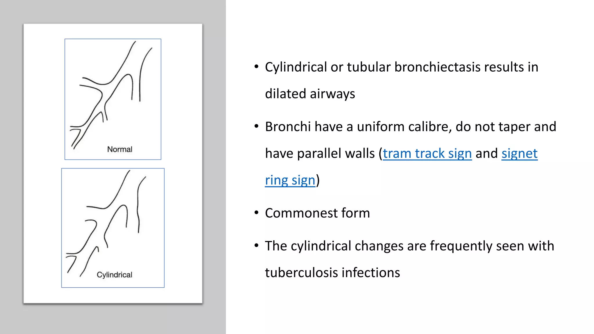 Bronchiectasis and Role of Surgical Management.pptx