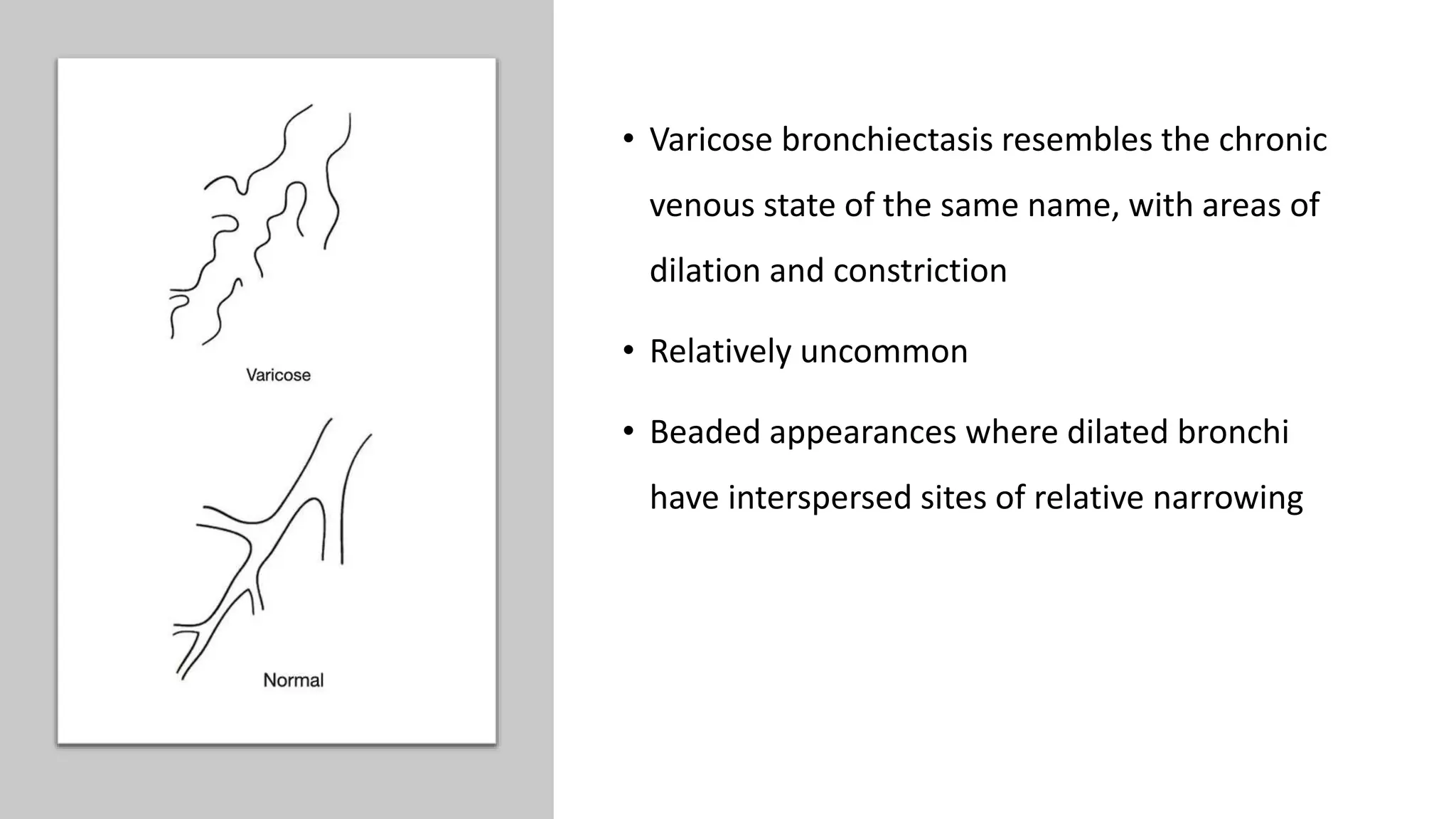 Bronchiectasis and Role of Surgical Management.pptx