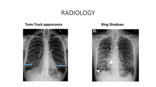 Bronchiectasis Tram Track