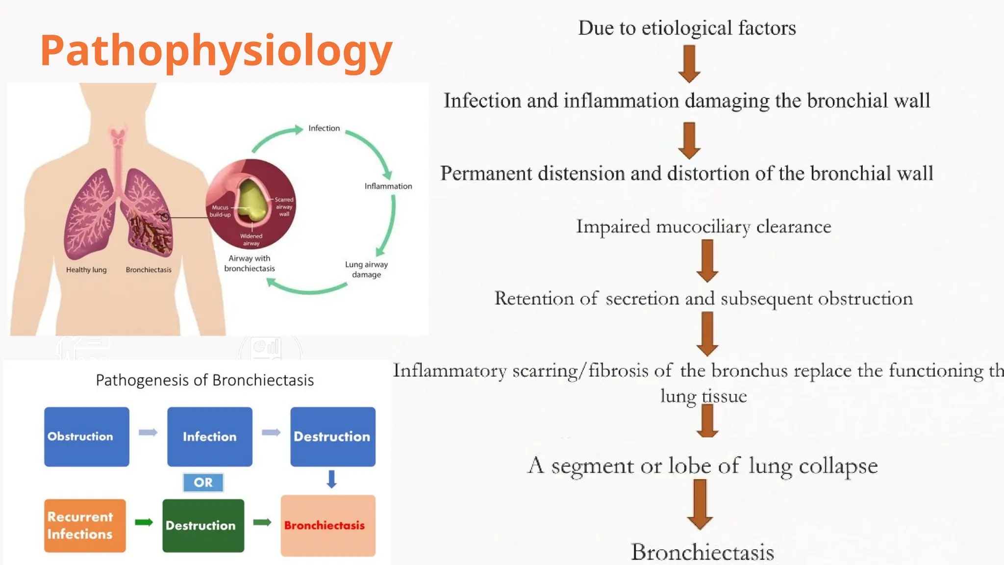 Bronchiectasis A chronic lung condition.ptx
