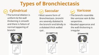 Bronchiectasis A chronic lung condition.ptx