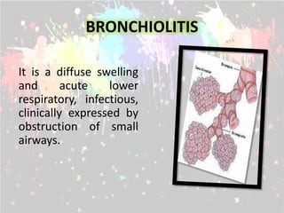 Bronchiolitis | PPTX