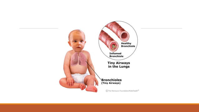 Bronchiolitis | Case Study | PPTX | Lung and Respiratory Health ...