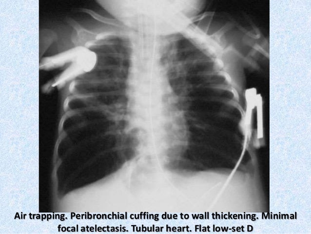 Bronchiolitis