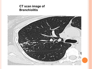 Bronchiolitis & Nursing care | PPTX