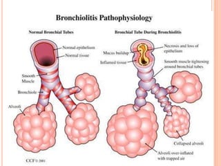 Bronchiolitis & Nursing care | PPTX