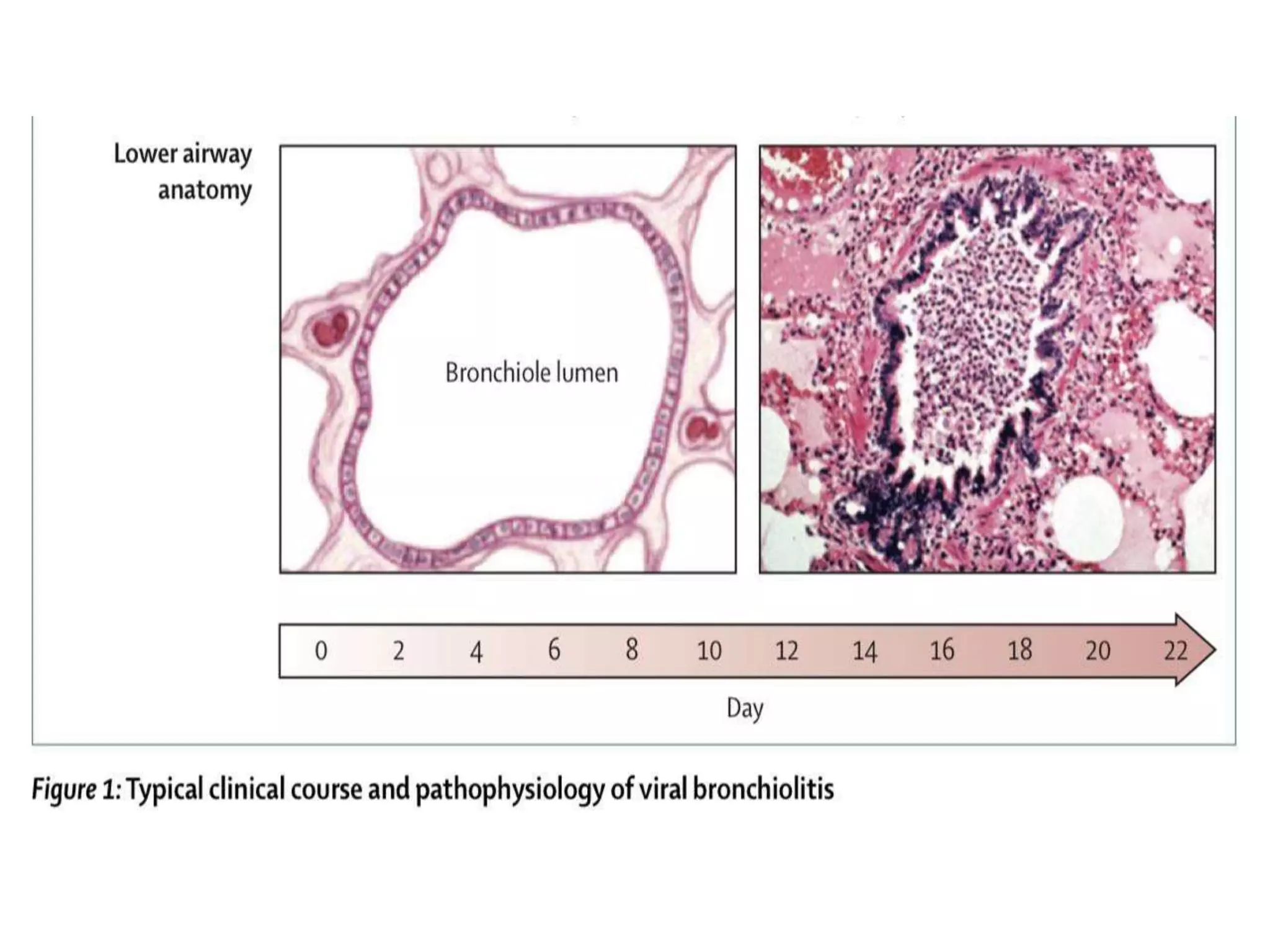 Bronchiolitis | PPTX
