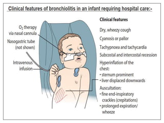 Bronchiolitis.pptx