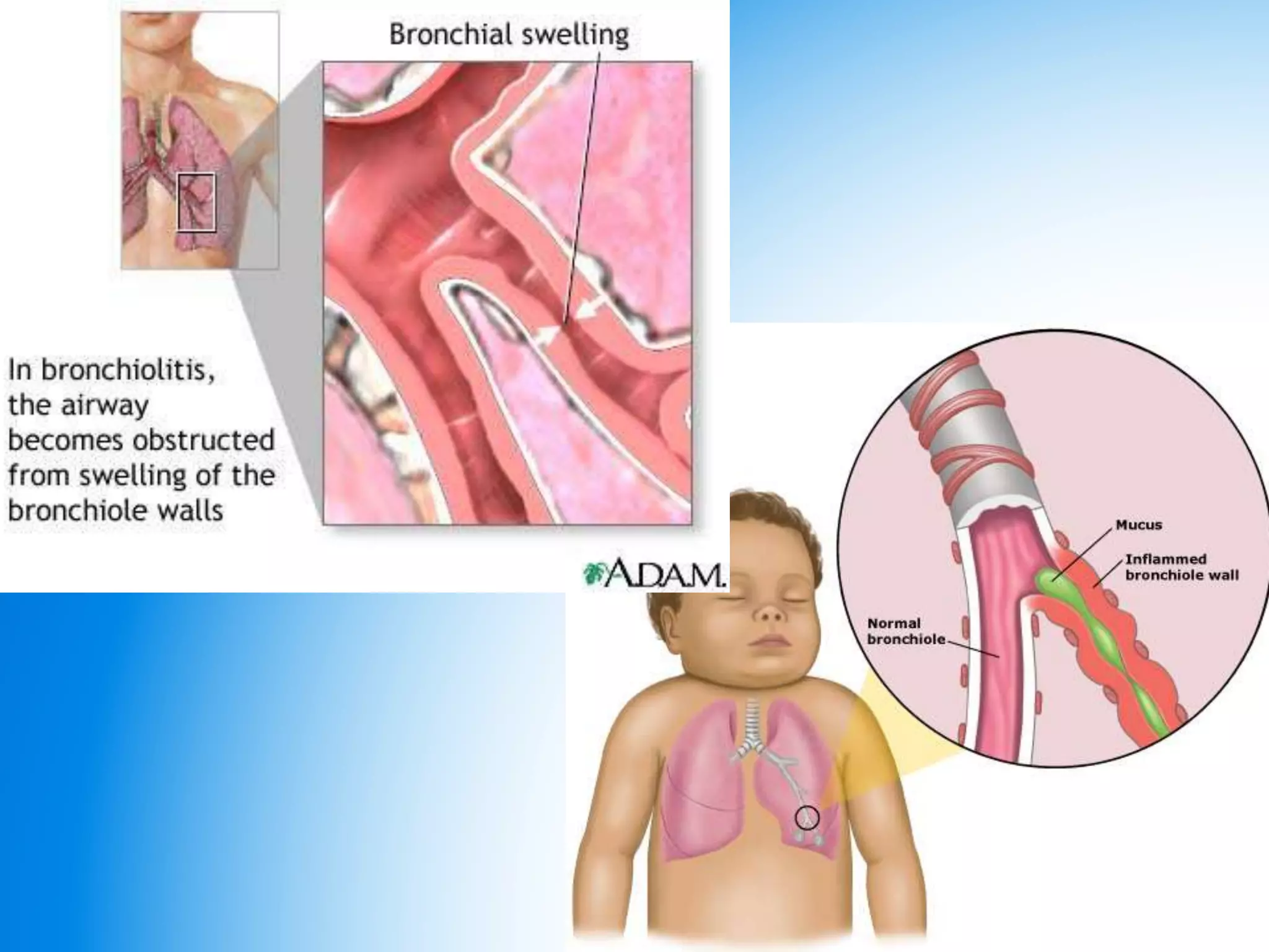 bronchiolitis in paediatrics | PPTX