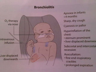 bronchiolitis in paediatrics | PPTX