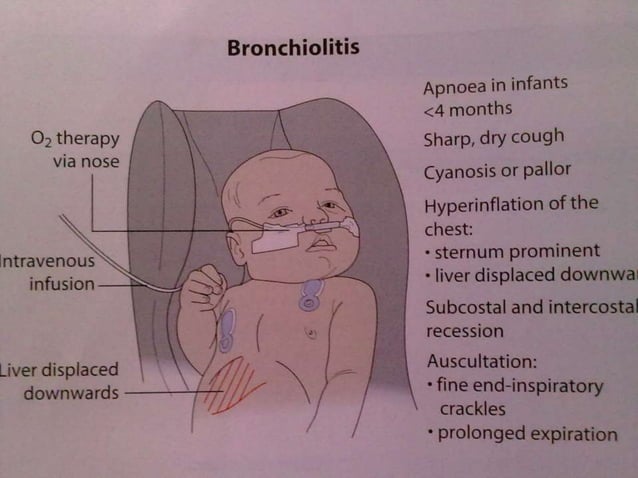 bronchiolitis in paediatrics | PPTX