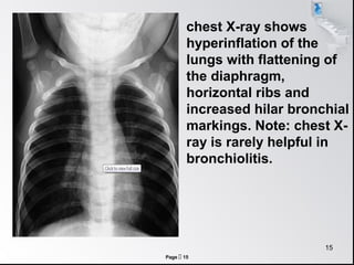 Bronchiolitis X Ray