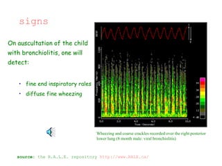 bronchiolitis in childrens with respiratory distress | PPT