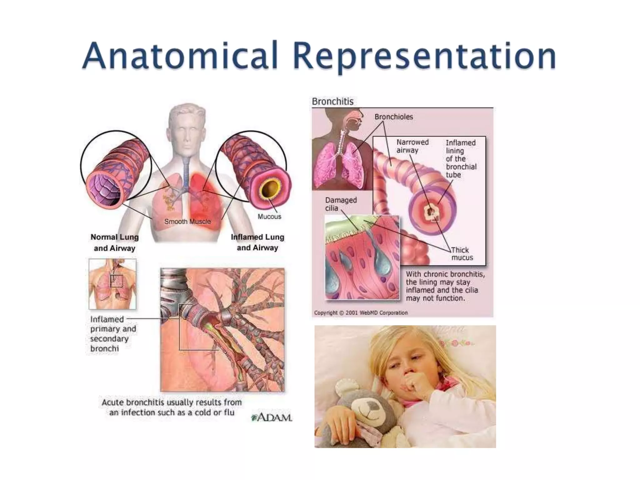 Bronchiolitis and bronchitis in children | PPTX